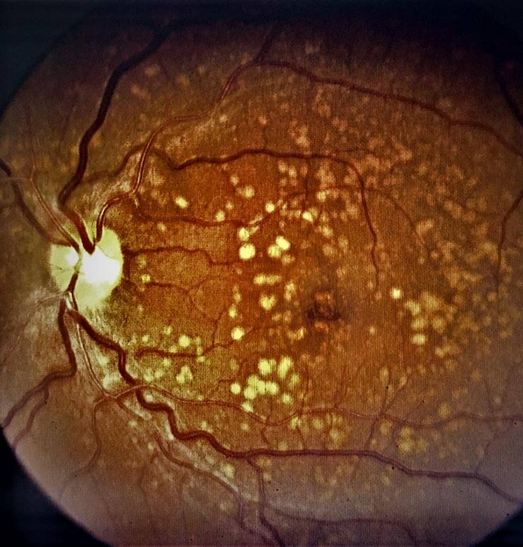 National Retina Institute Macular Degeneration Maryland