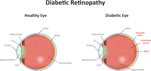 National Retina Institute | Diabetic Retinopathy | Maryland